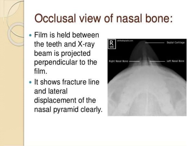 Radiology of nose and paranasal sinuses | PPTX