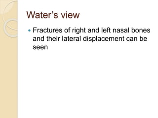 Radiology of nose and paranasal sinuses | PPTX