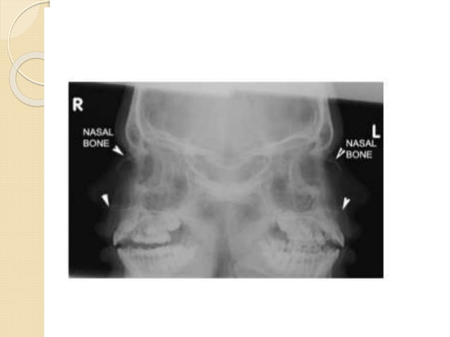 Radiology of nose and paranasal sinuses | PPTX