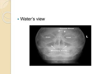 Radiology of nose and paranasal sinuses | PPTX
