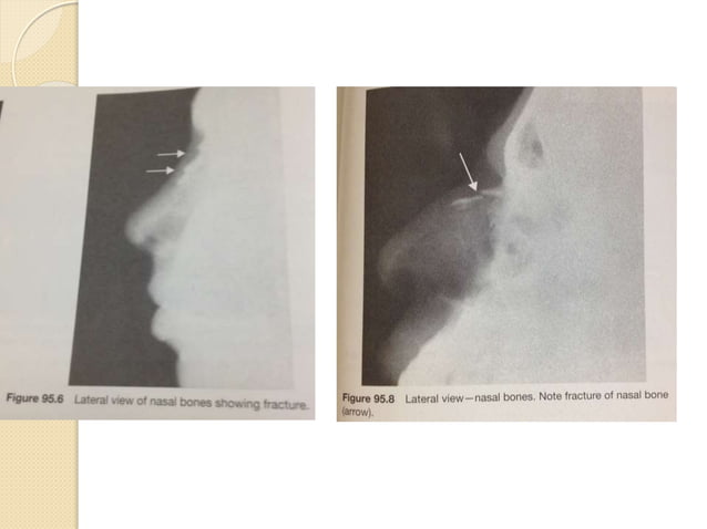 Radiology of nose and paranasal sinuses | PPTX