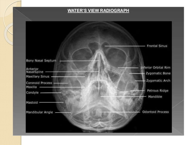 Radiology of nose and paranasal sinuses | PPTX