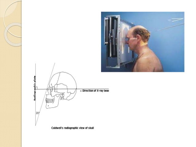 Radiology of nose and paranasal sinuses | PPTX