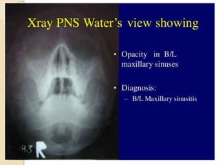Paranasal Sinuses X Ray