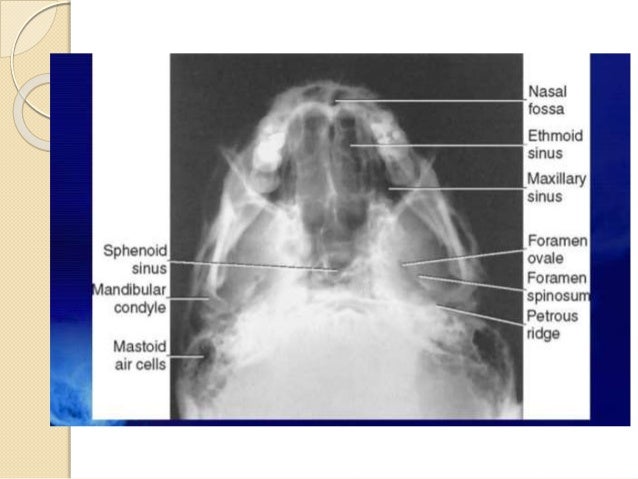 Radiology of nose and paranasal sinuses