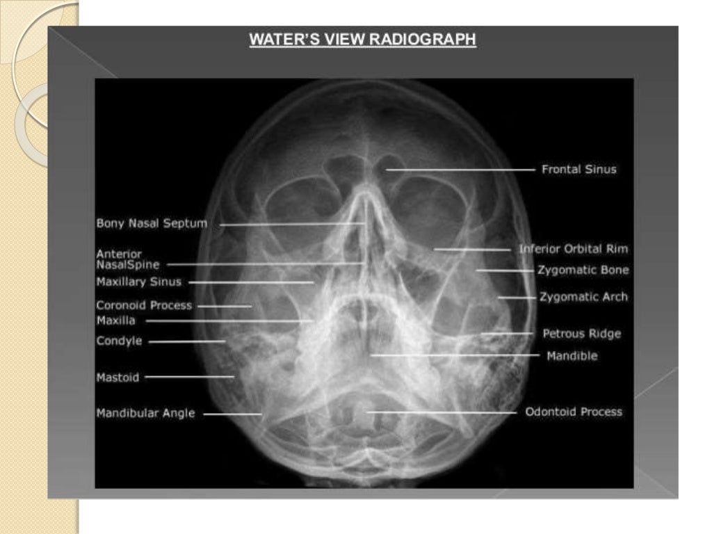 Radiology of nose and paranasal sinuses
