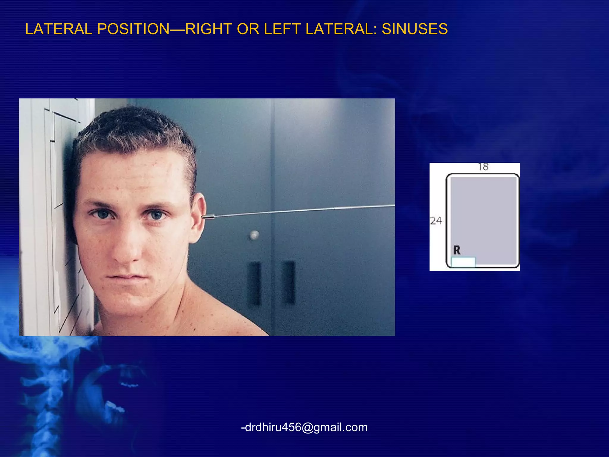 Radiology of nose and pns (by drdhiru456) | PPT