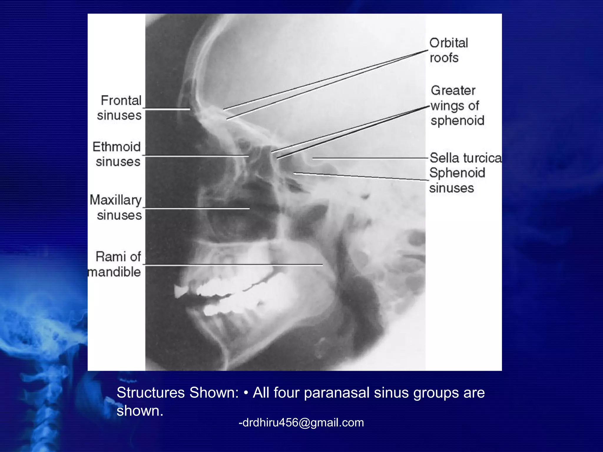 Radiology of nose and pns (by drdhiru456) | PPT