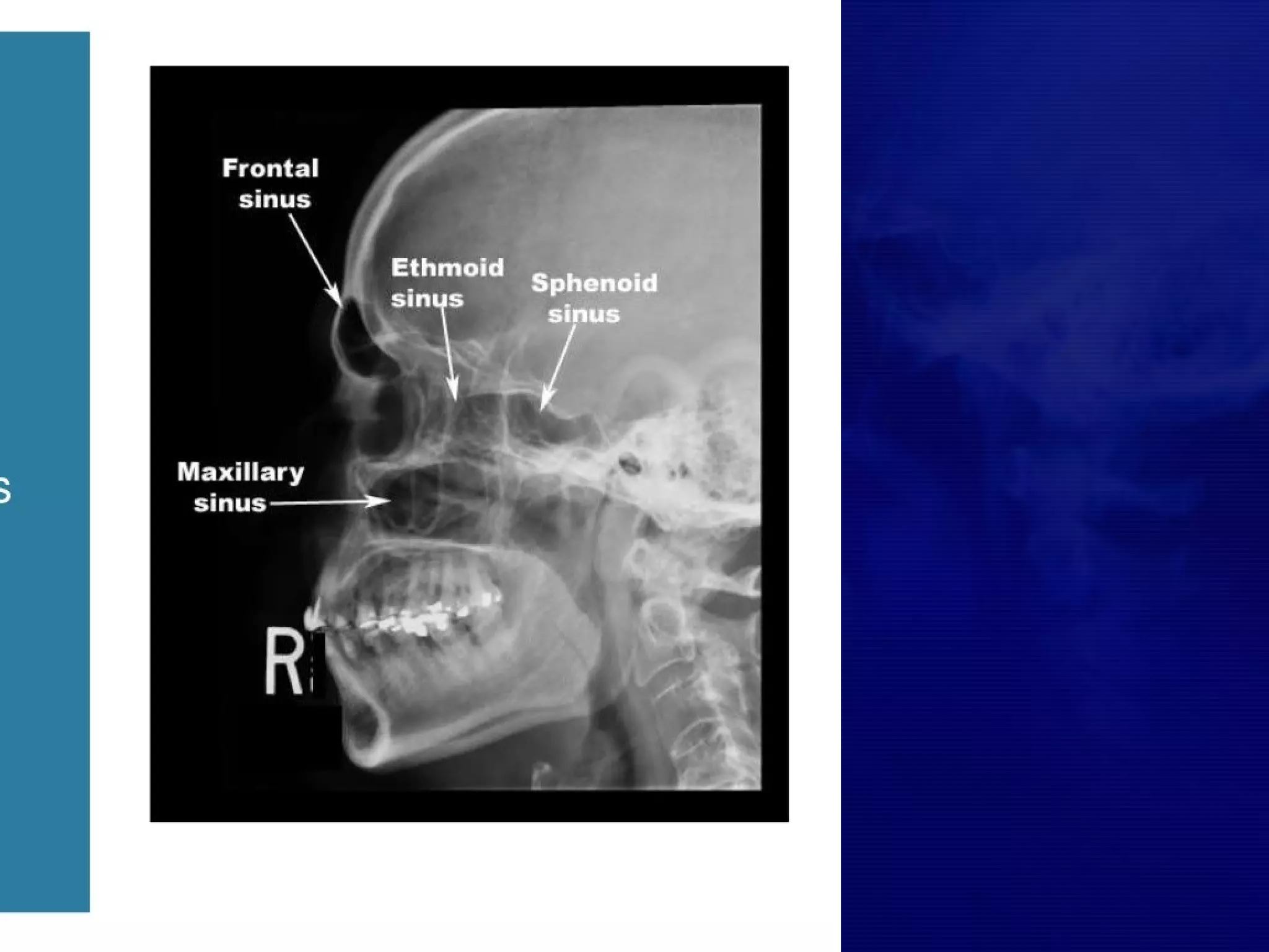 Radiology of nose and pns (by drdhiru456) | PPT