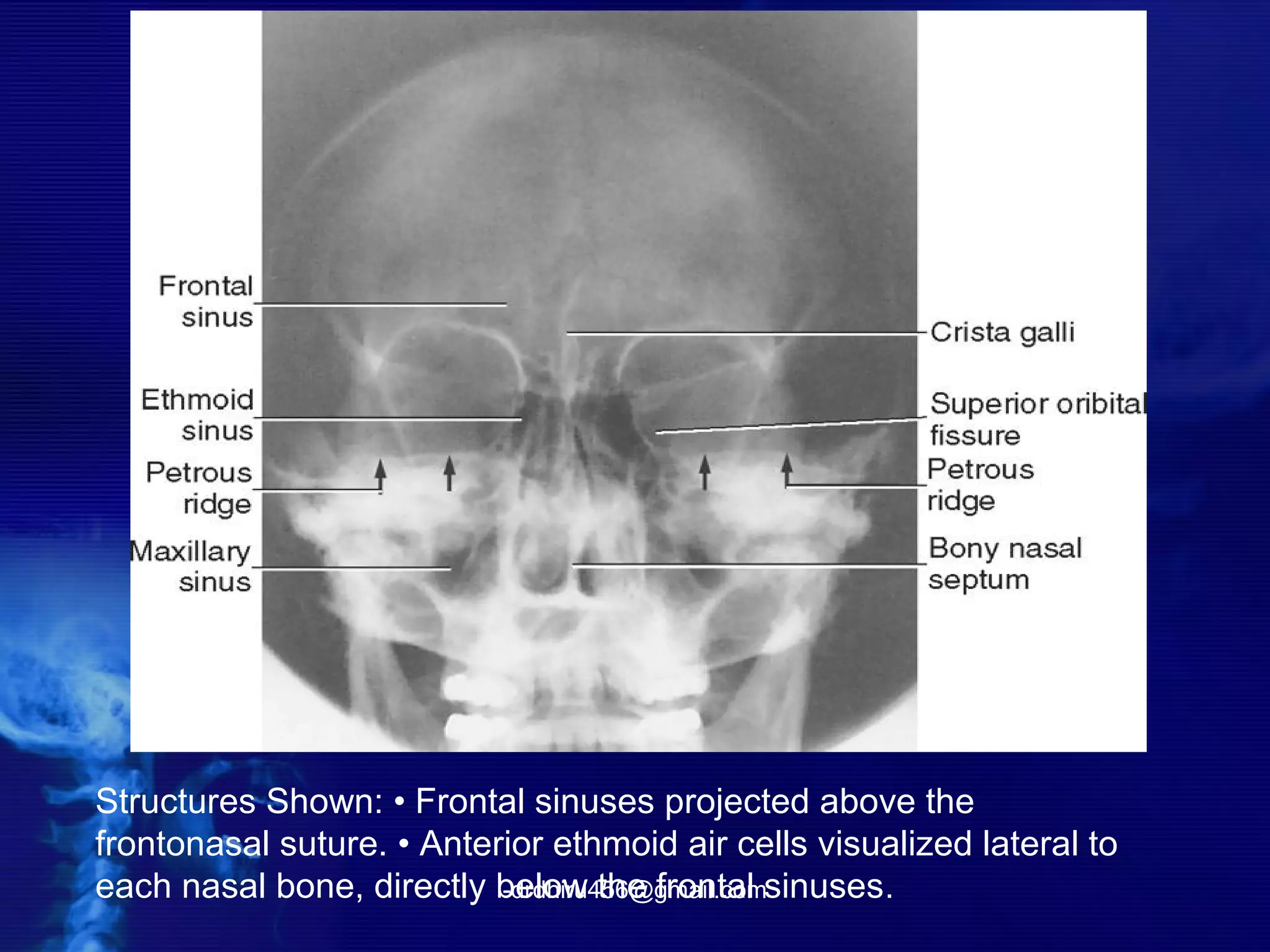 Radiology of nose and pns (by drdhiru456) | PPT