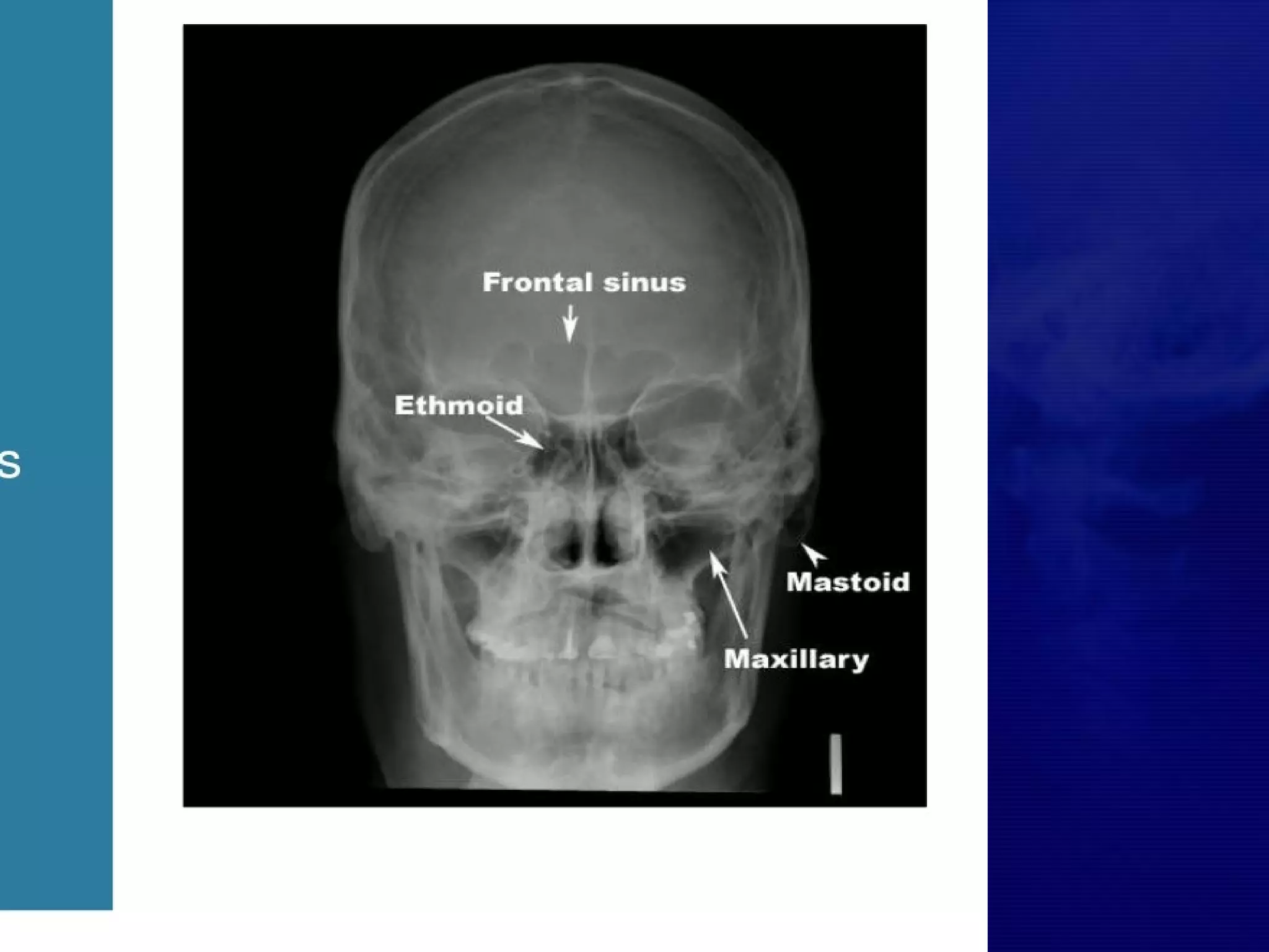 Radiology of nose and pns (by drdhiru456) | PPT