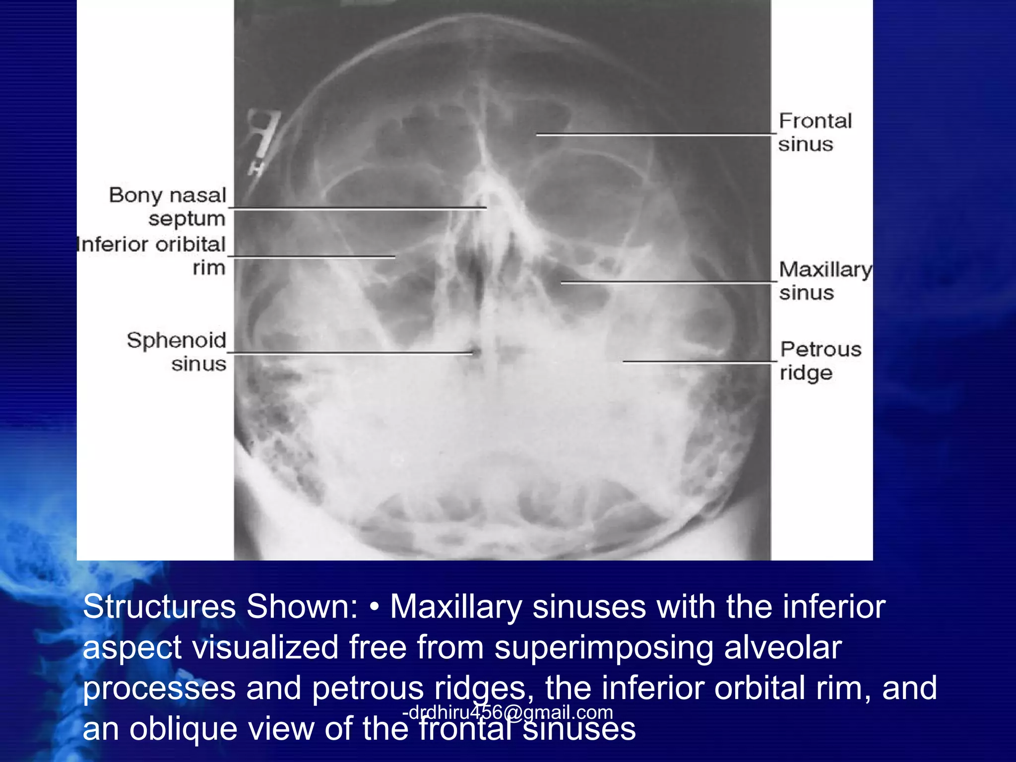 Radiology of nose and pns (by drdhiru456) | PPT