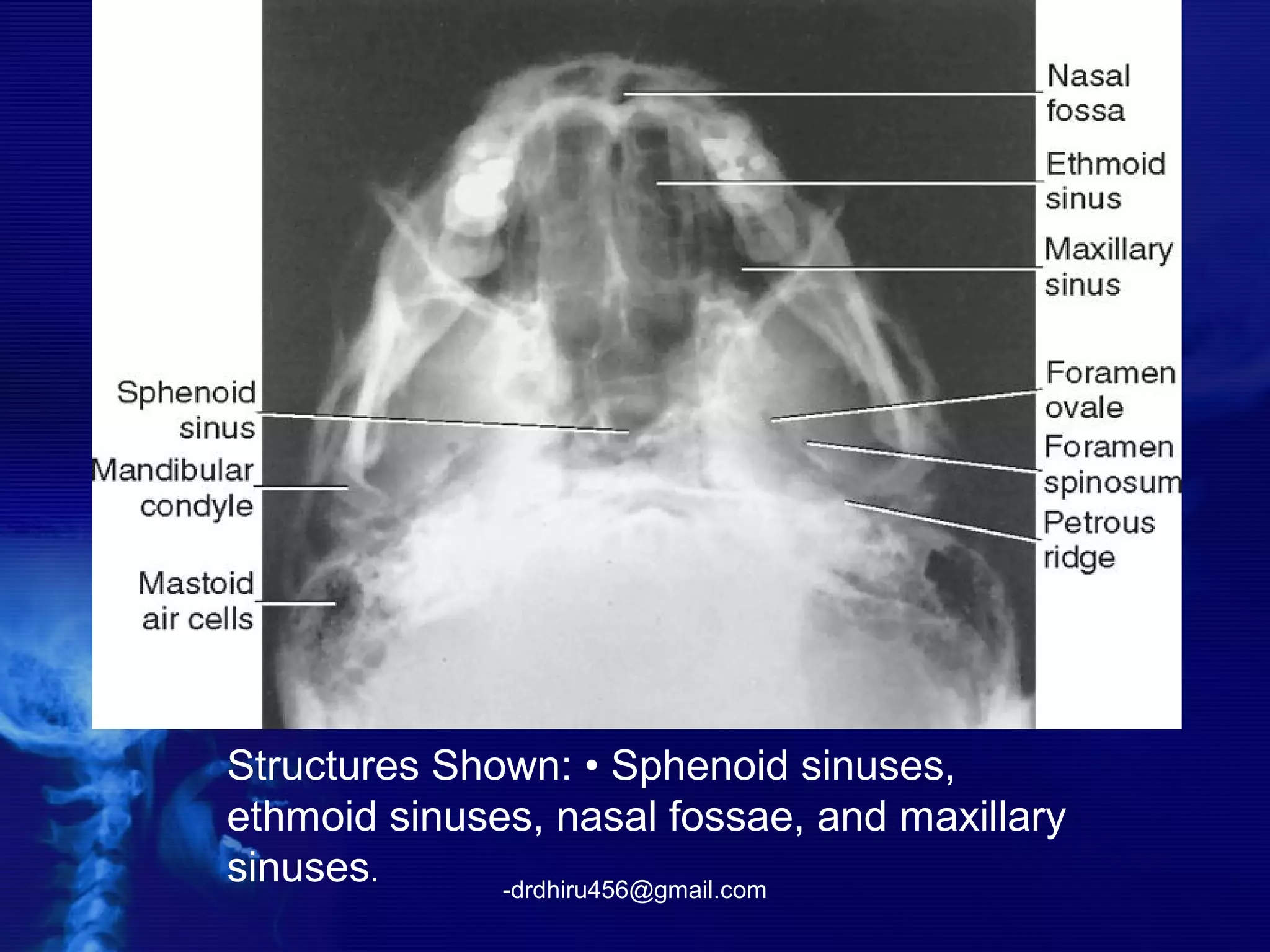 Radiology of nose and pns (by drdhiru456) | PPT