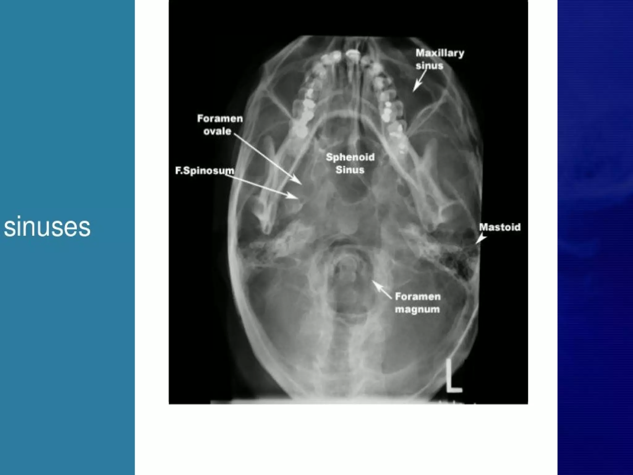 Radiology of nose and pns (by drdhiru456) | PPT
