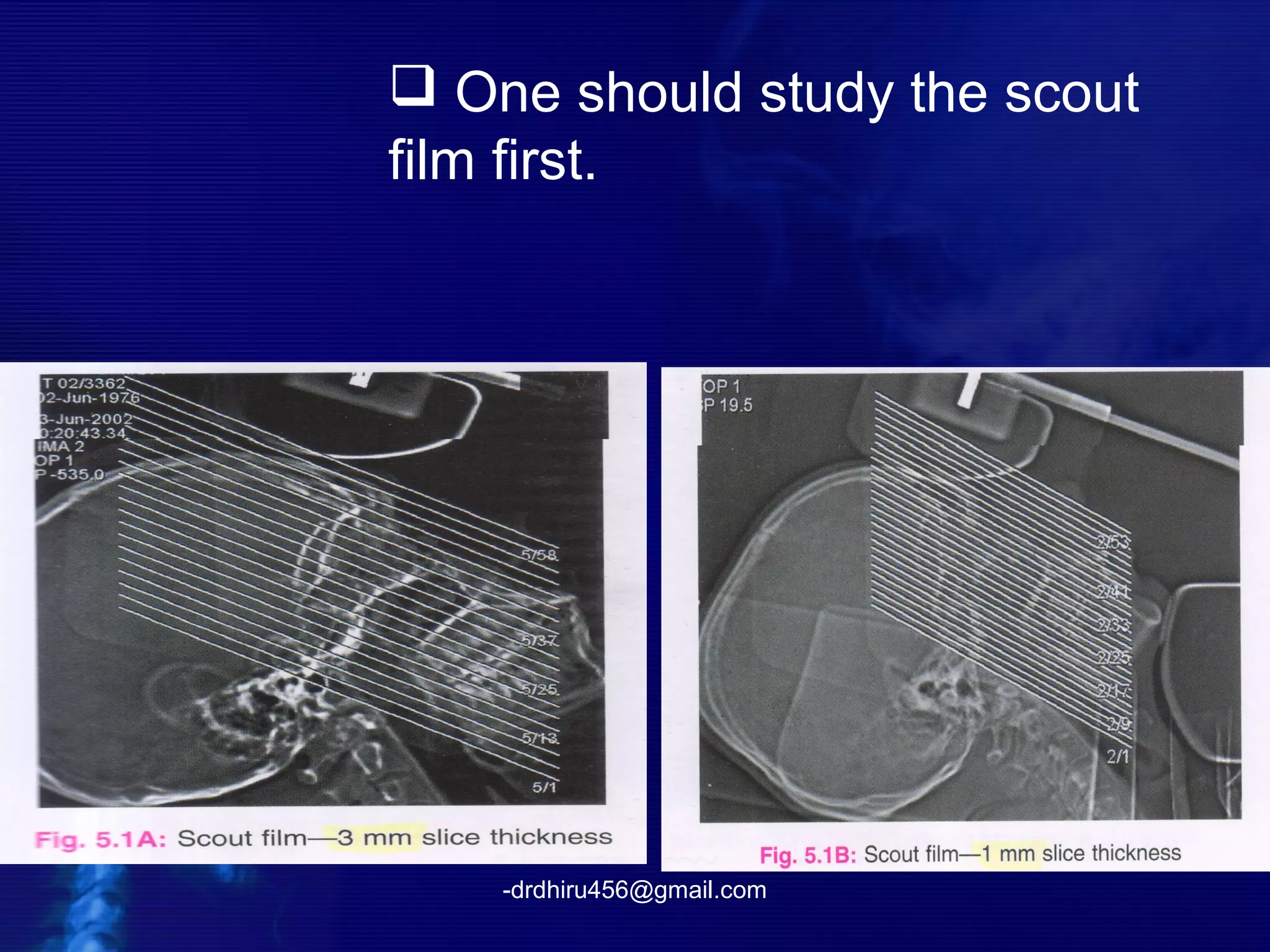 Radiology of nose and pns (by drdhiru456) | PPT