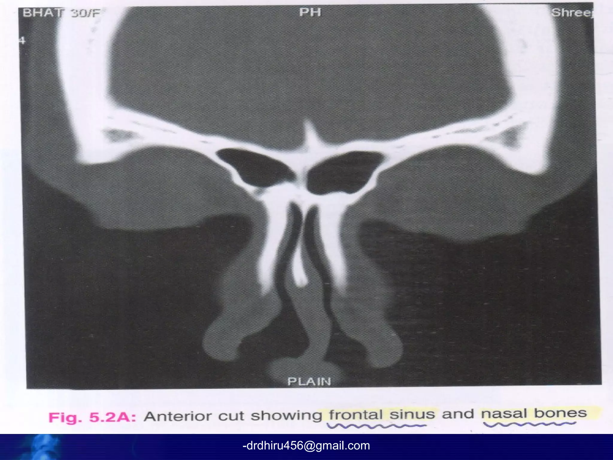 Radiology of nose and pns (by drdhiru456) | PPT
