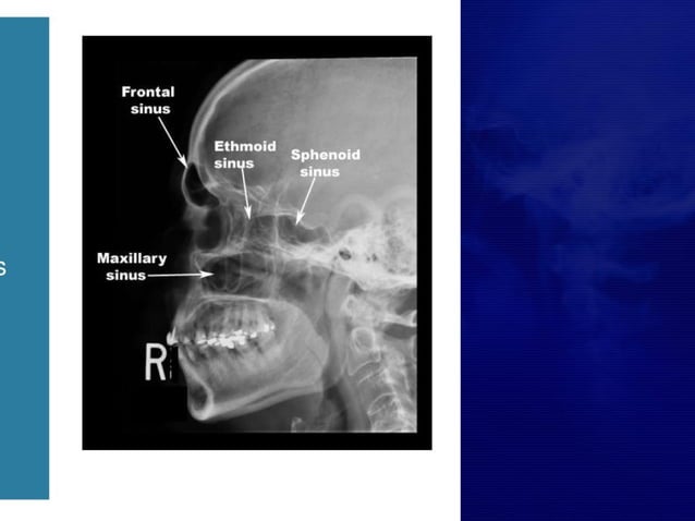 Radiology of nose and pns (by drdhiru456) | PPT | Ear, Nose and Throat ...
