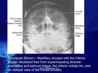 Sphenoid Sinus X Ray