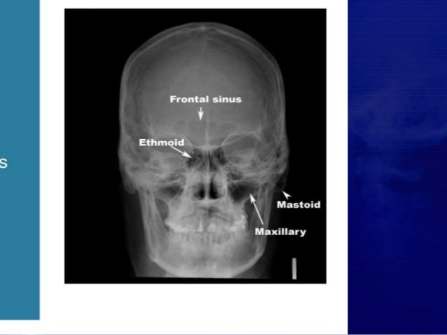 Radiology of nose and pns (by drdhiru456)