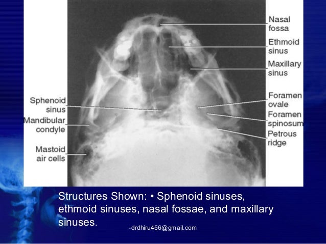 Radiology of nose and pns (by drdhiru456)