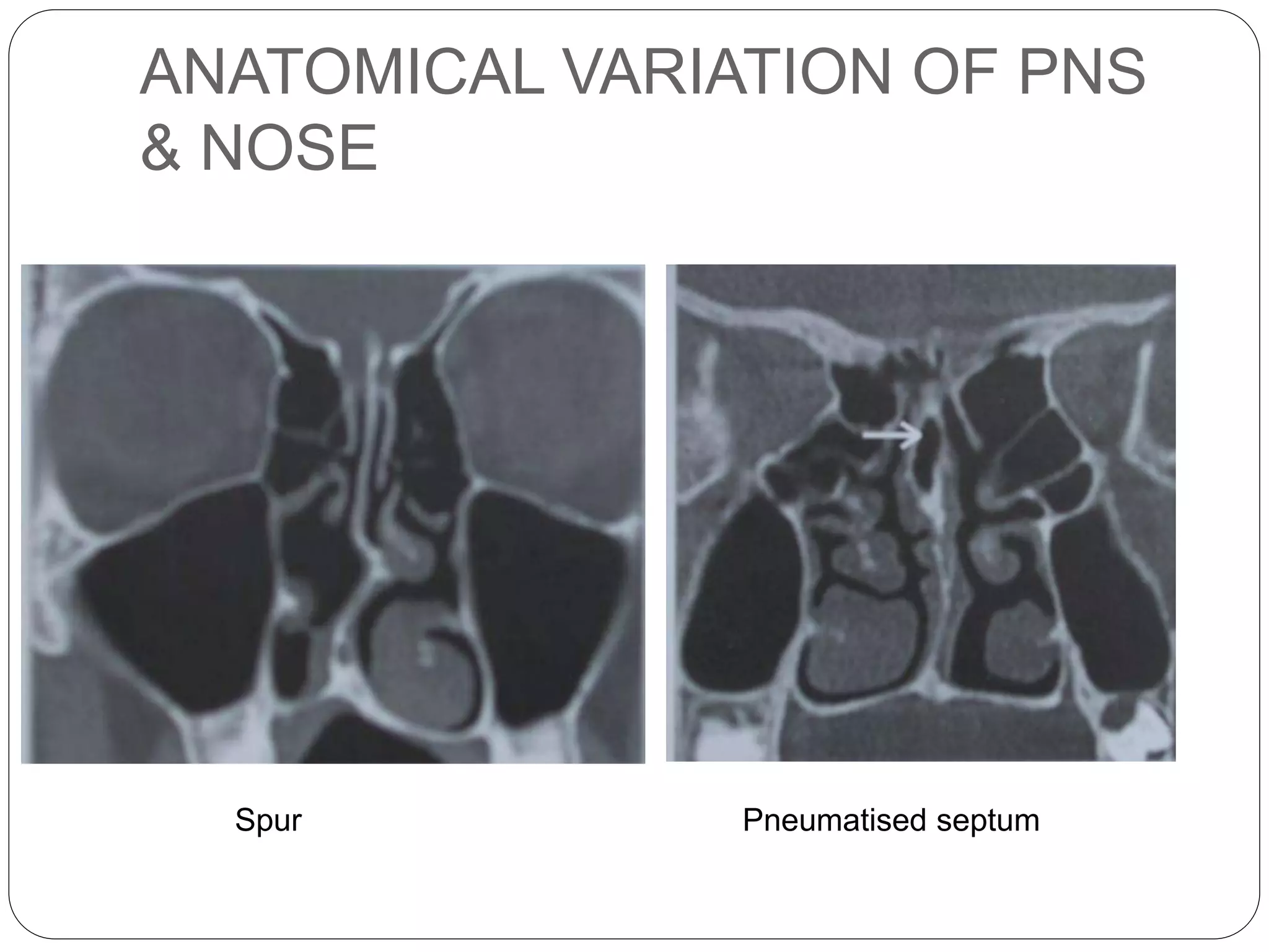 SANTOSH jaiswal Radiology of Nose n PNS.pptxbackup.pptx