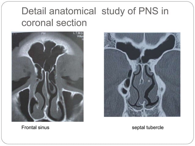 SANTOSH jaiswal Radiology of Nose n PNS.pptxbackup.pptx