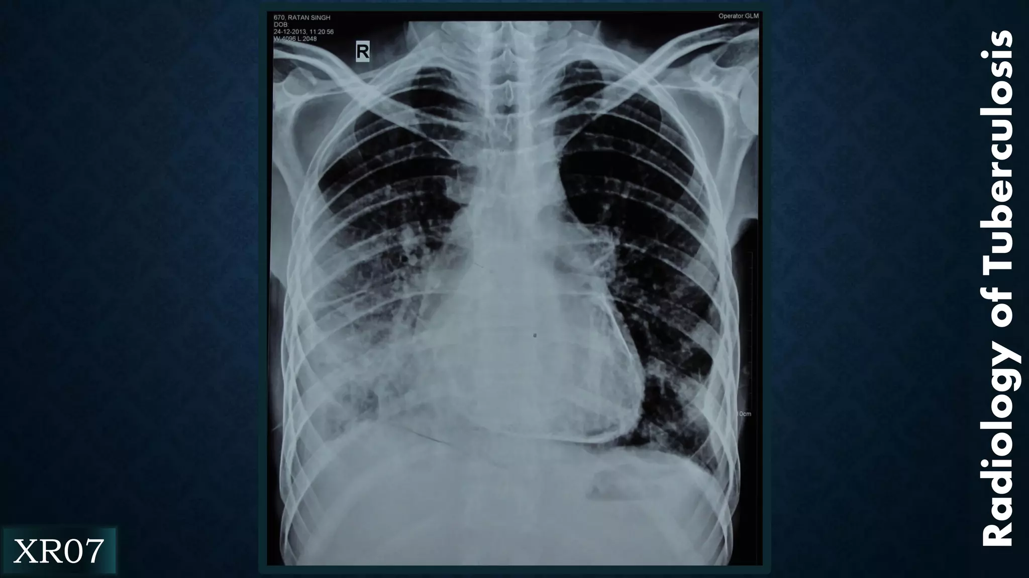 Radiology of Tuberculosis | PDF