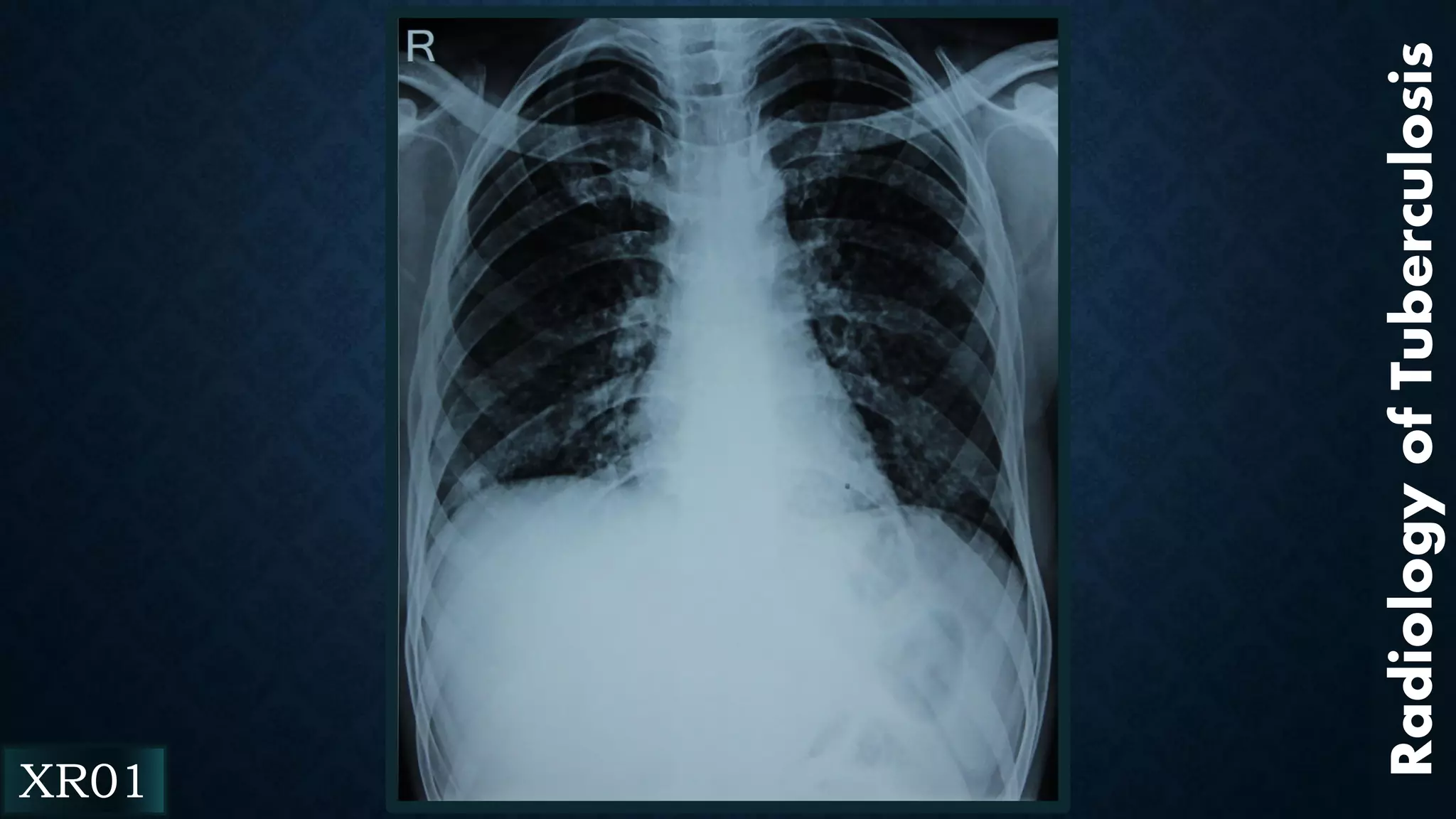 Radiology of Tuberculosis | PDF