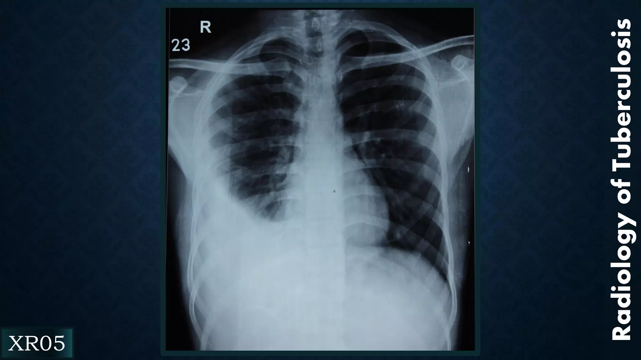 Radiology of Tuberculosis | PDF
