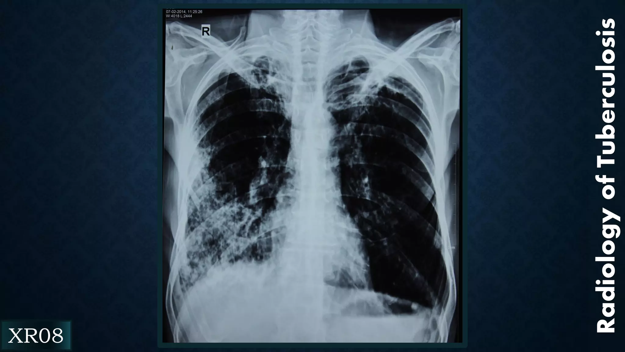 Radiology of Tuberculosis | PDF