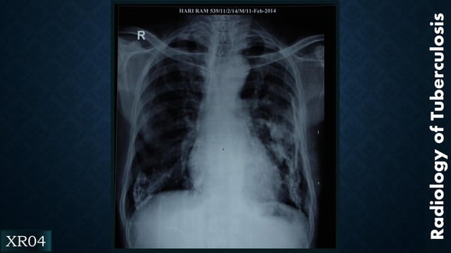 Radiology of Tuberculosis | PDF | Lung and Respiratory Health ...
