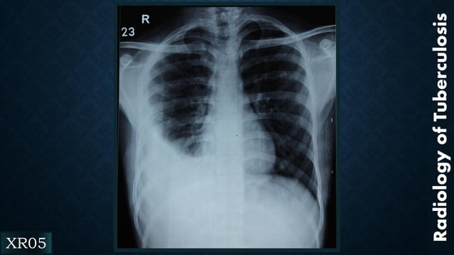 Radiology of Tuberculosis | PDF | Lung and Respiratory Health ...