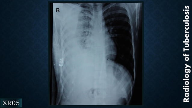 Radiology of Tuberculosis | PDF | Lung and Respiratory Health ...