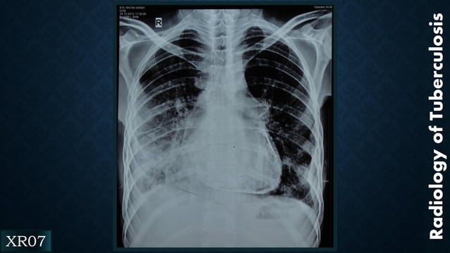 Radiology of Tuberculosis | PDF | Lung and Respiratory Health ...