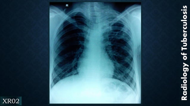 Radiology of Tuberculosis | PDF | Lung and Respiratory Health ...
