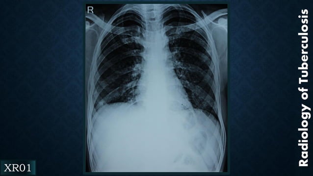 Radiology of Tuberculosis | PDF | Lung and Respiratory Health ...
