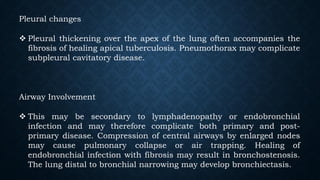 Radiology of Tuberculosis | PDF