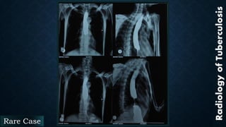 Radiology of Tuberculosis | PDF