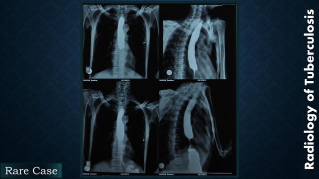 Radiology of Tuberculosis | PDF | Lung and Respiratory Health ...