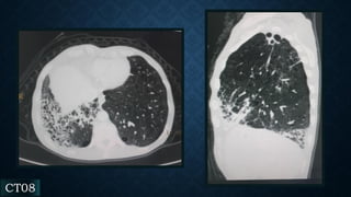 Radiology of Tuberculosis | PDF