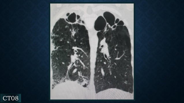 Radiology of Tuberculosis | PDF | Lung and Respiratory Health ...