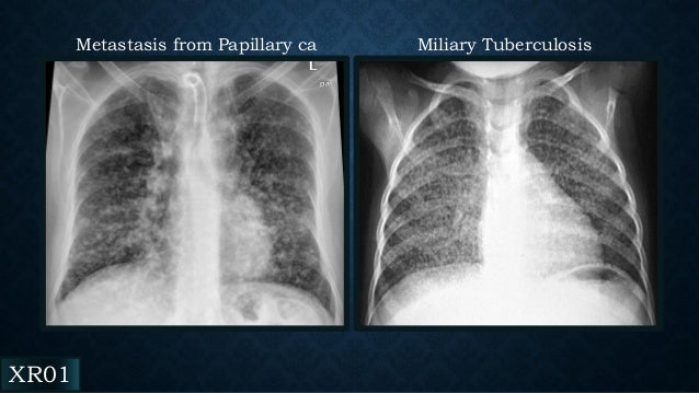 Radiology of Tuberculosis