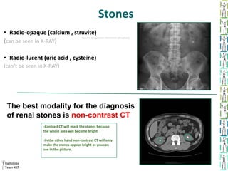 Struvite Stone X Ray