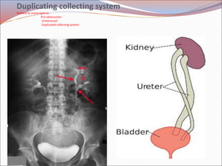 Radiology of urogenital systsm slide share | PPT
