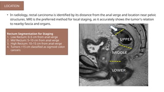 Radiology Overview of Rectal Carcinoma.pptx