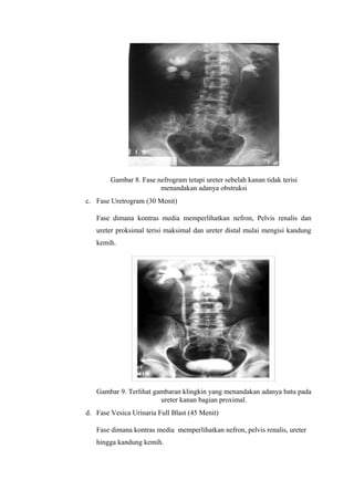 Radiology pada urolithiasis | DOC