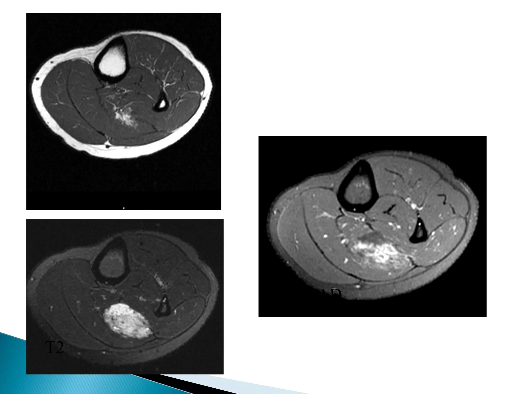 Radiology pediatric bone tumors | PPT