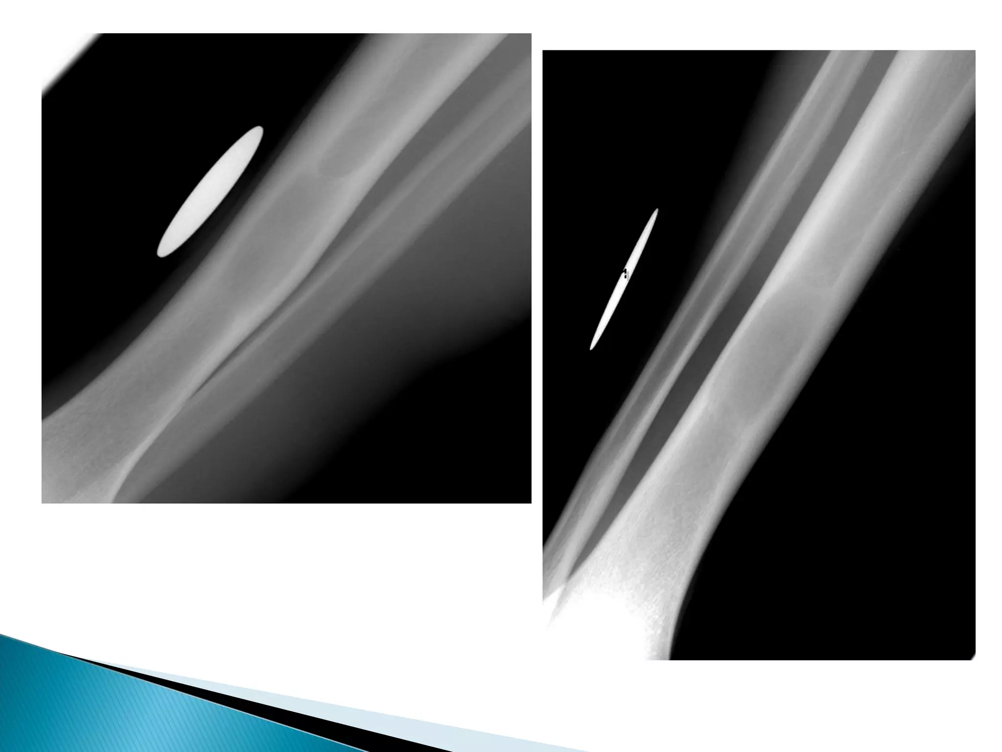 Radiology pediatric bone tumors | PPT