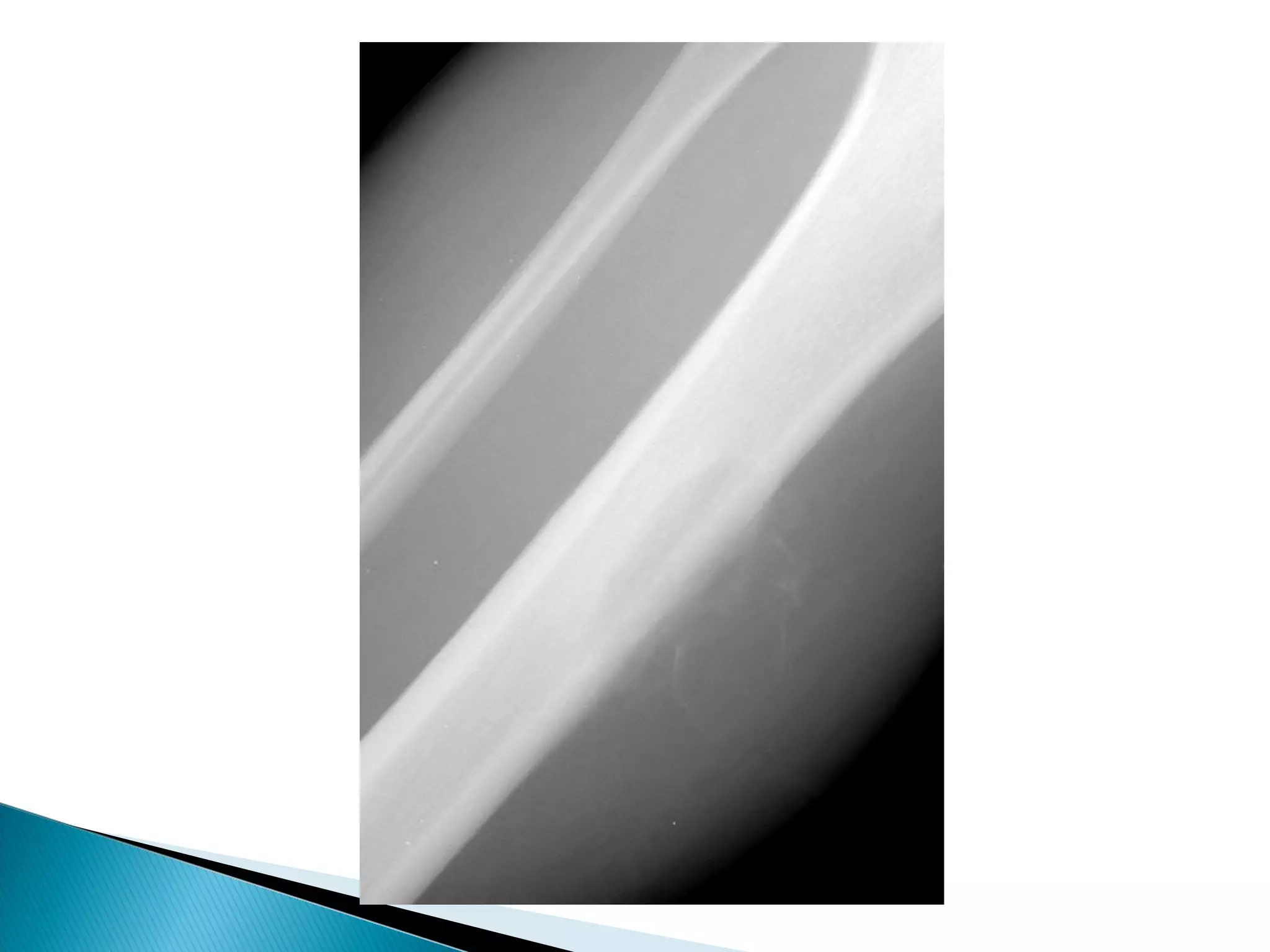 Radiology pediatric bone tumors | PPT