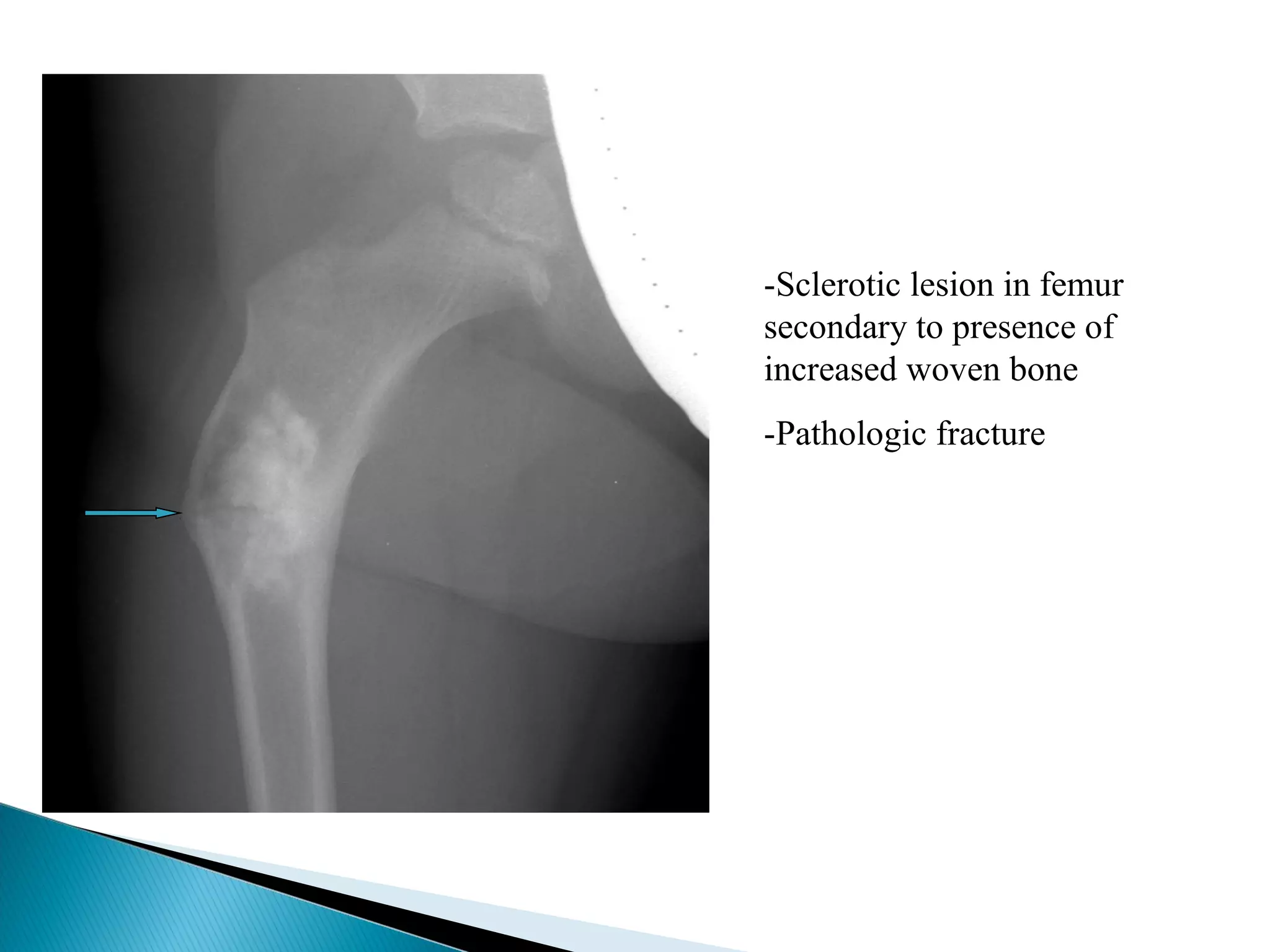 Radiology pediatric bone tumors | PPT